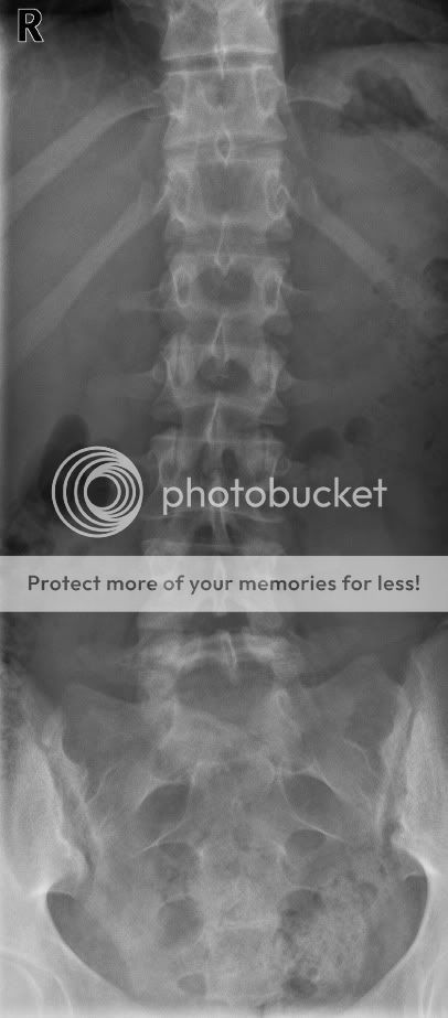 Door de knie zakken + rugklachten en heupklachten. - Medische Forum ...